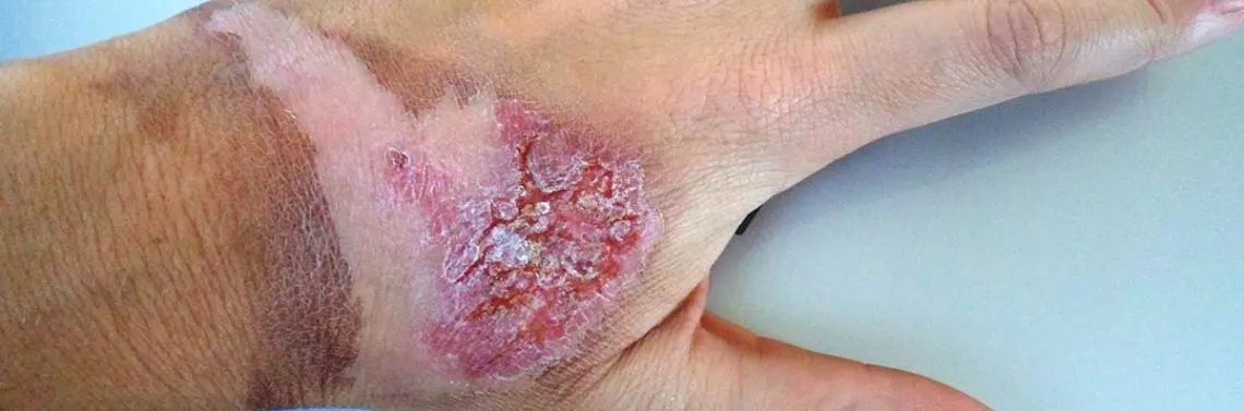 Trudno gojące się rany i oparzenia – regeneracja komórek i procesy ...